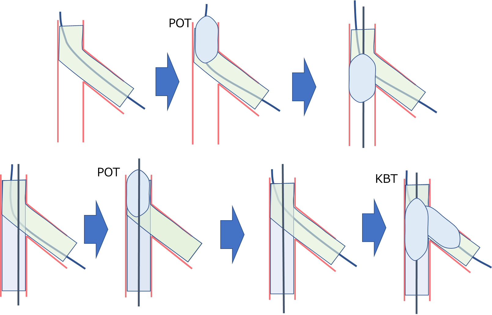 分岐部病変に対するステント留置法 T-stent? Crush? Culotte? | カテっ子臨床工学技士