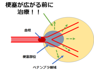 AISとは？ 急性虚血性脳卒中とは？ | カテっ子臨床工学技士