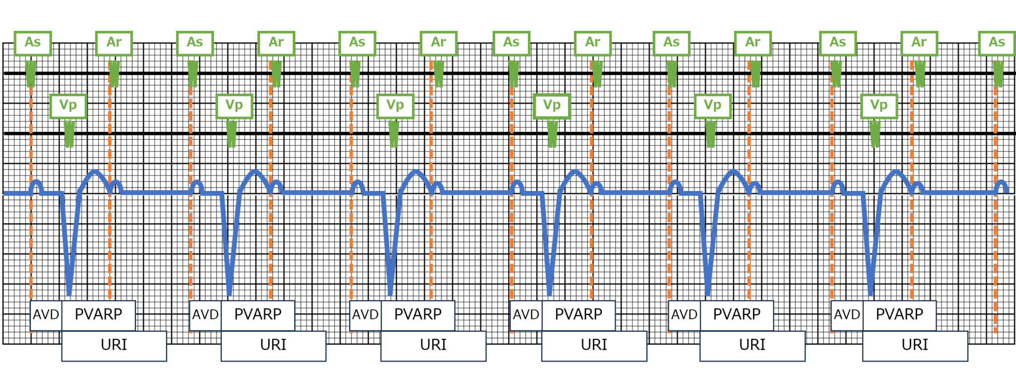 2：1作動とは？ ウェンケバッハ作動とは？【トラブル作動】 | カテっ子臨床工学技士